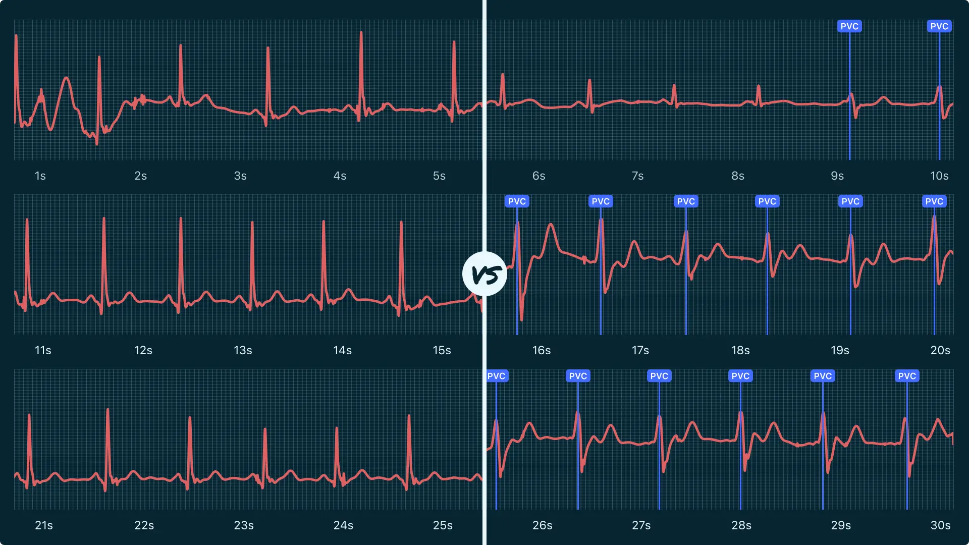 Sinus Rhythm Vs. Accelerated Idioventricular Rhythm on Your Watch ECG ...